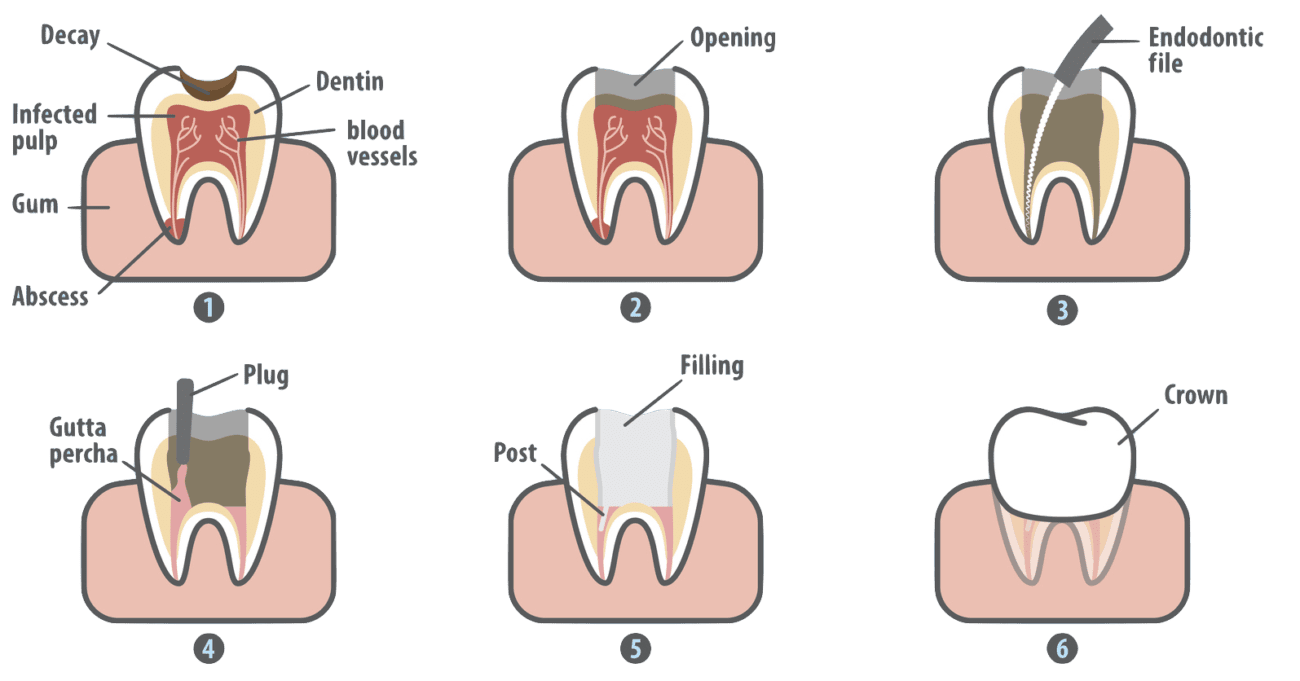 Root Canal Northborough MA Painless Root Canal Therapy